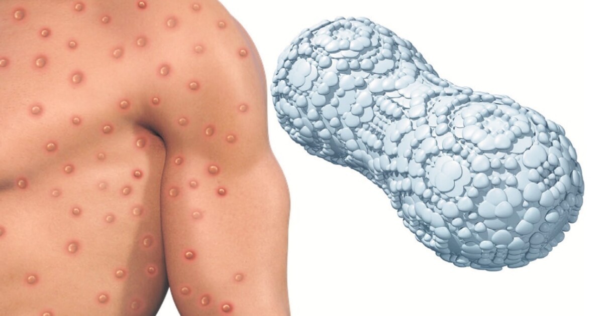 O que já se sabe sobre a nova varíola e como é possível se proteger ...